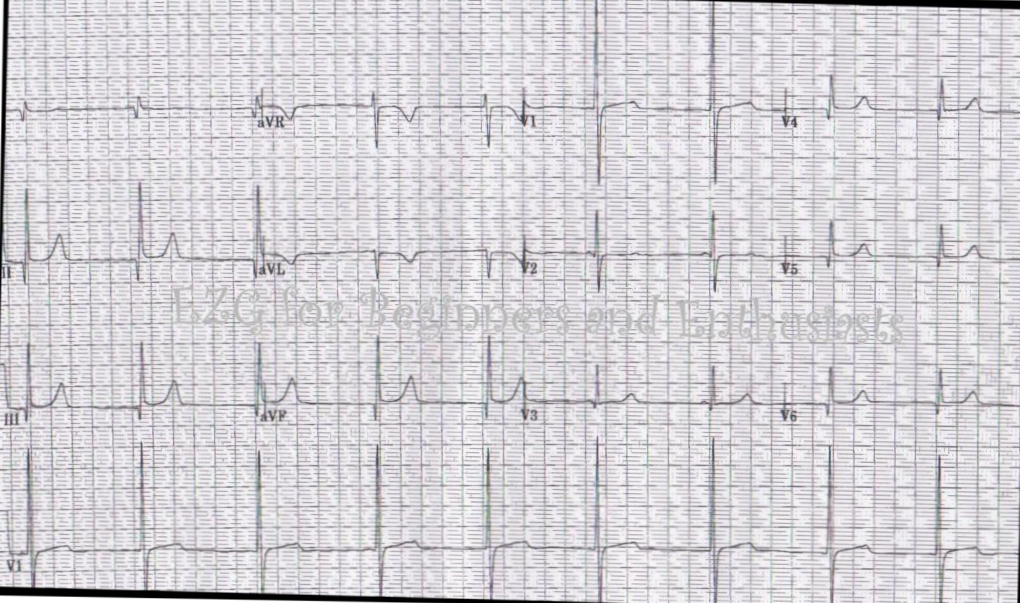 Dextrocardia | ECG Guru - Instructor Resources Dextrocardia | ECG Guru - Instructor Resources